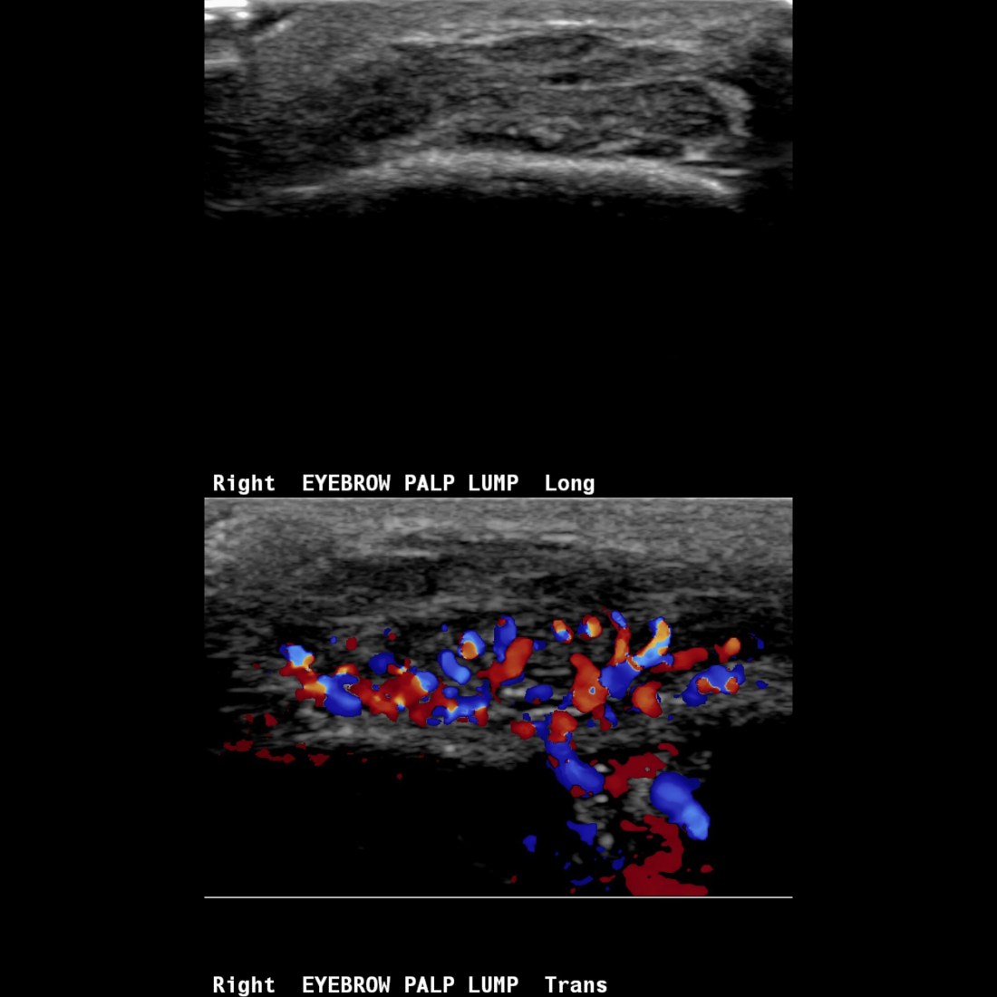 Infant with a right eyebrow mass | Pediatric Radiology Case | Pediatric ...