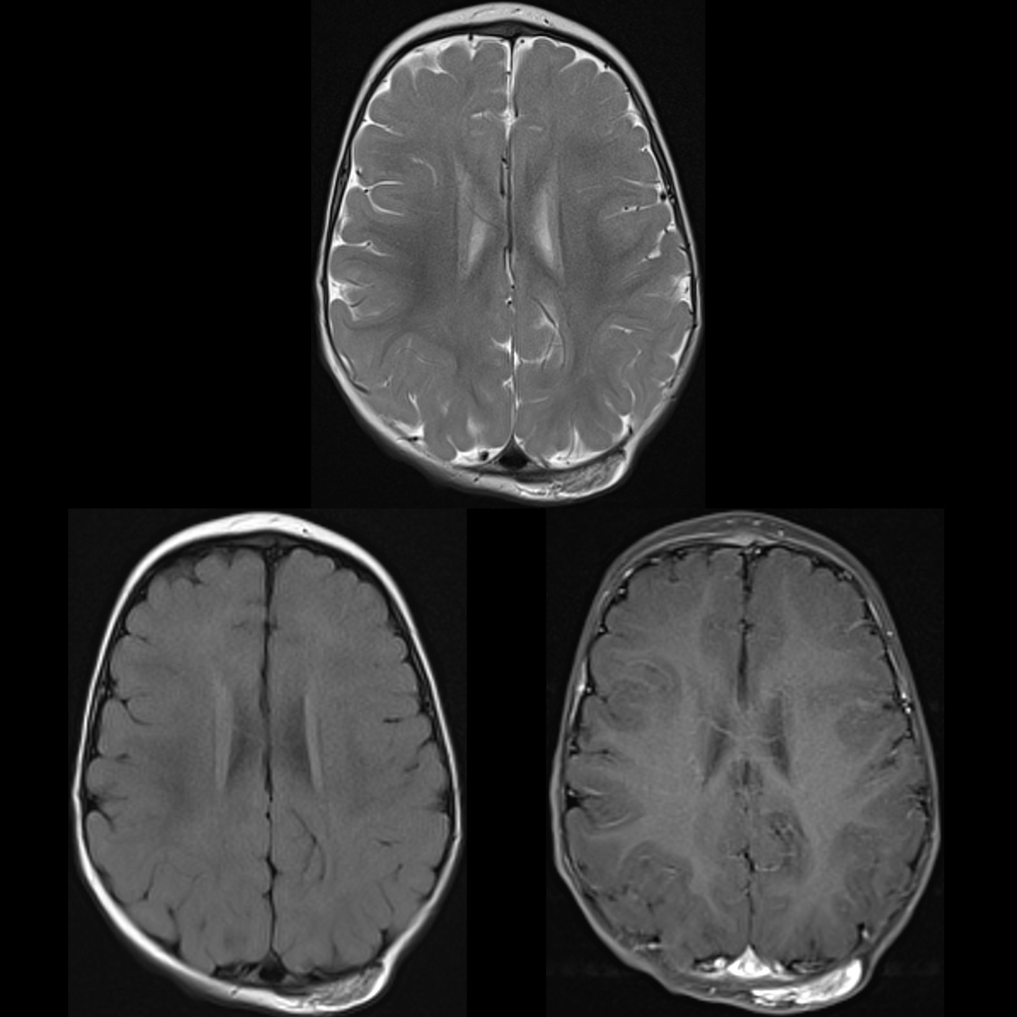 HemangiomaSoftTissue01ScalpMRT2T1T1C13mo | Pediatric Radiology Case ...