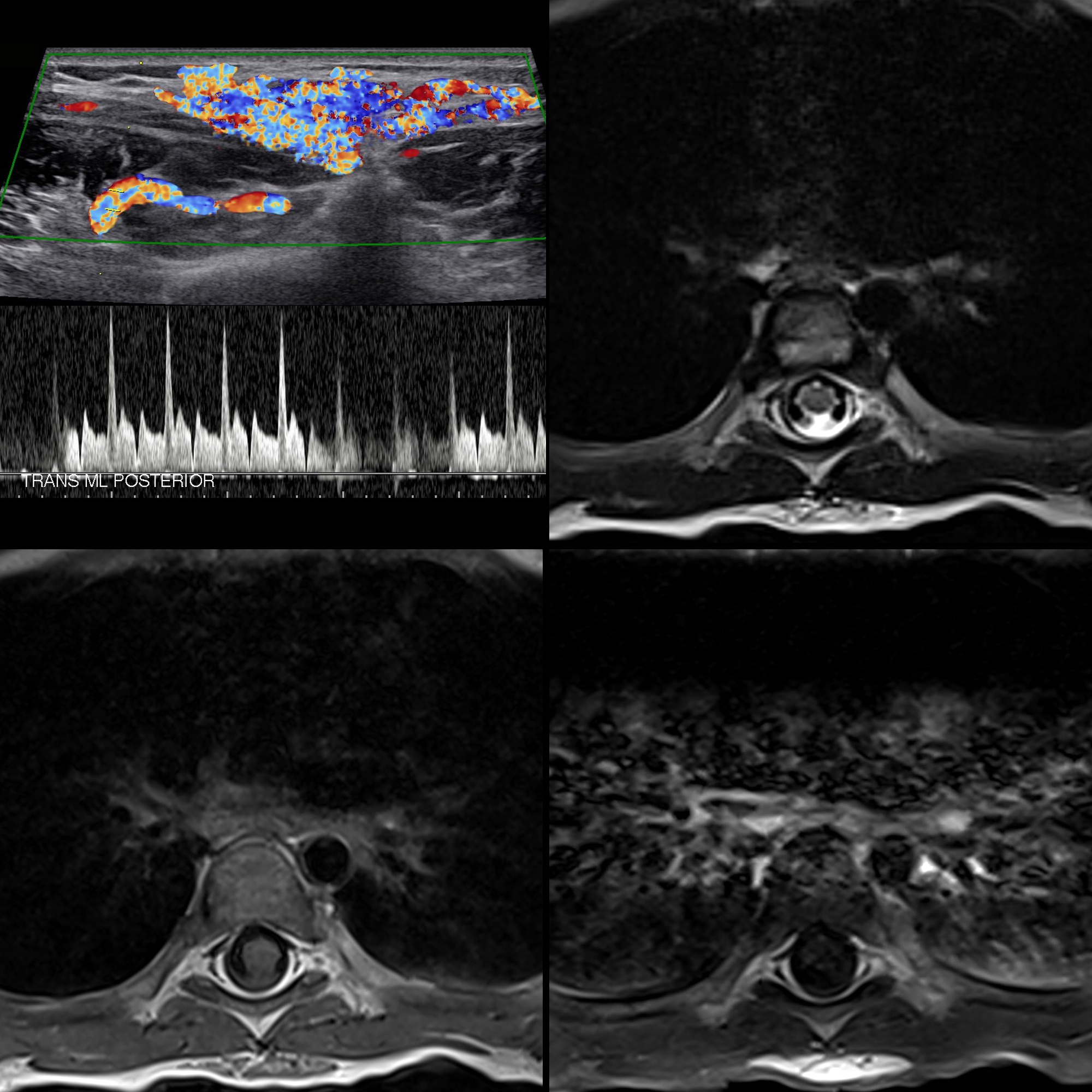 Pediatric Soft Tissue Hemangioma | Pediatric Radiology Reference ...