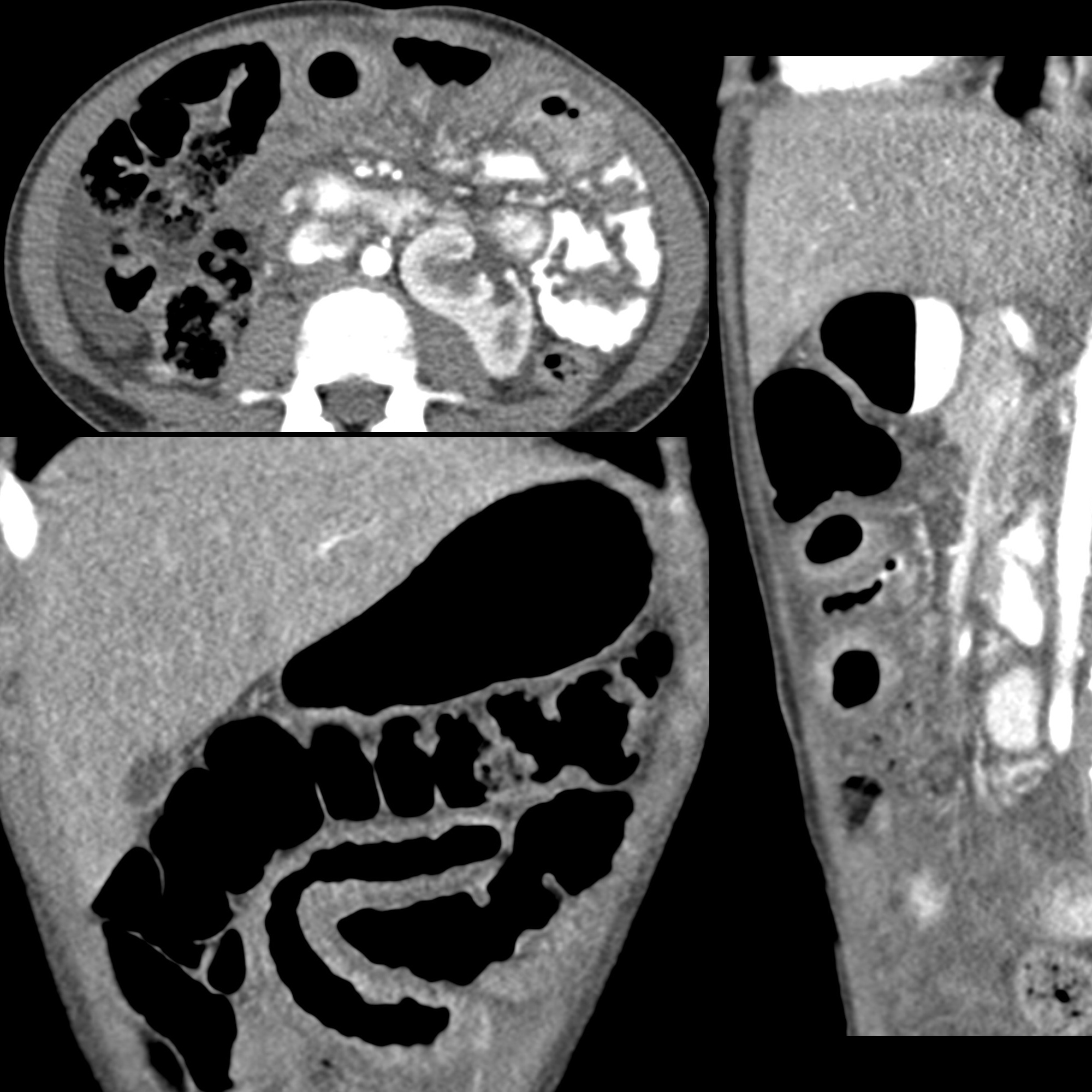 HenochSchonleinPurpura02MDAbdominalPainThickenedMildlyEnhancingLoopProx ...