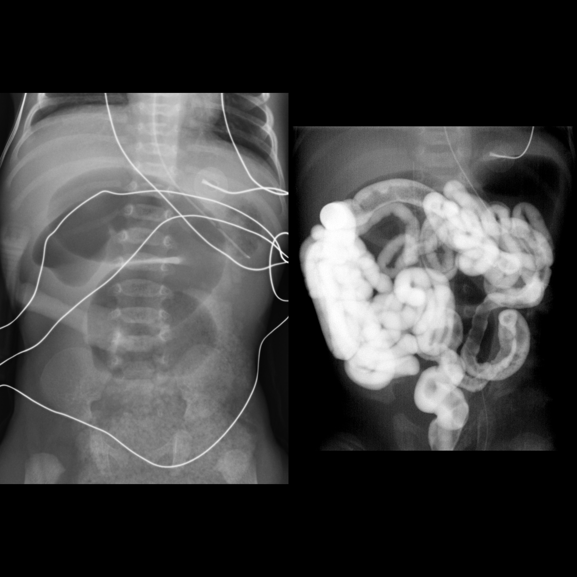 JejunalAtresia01MDTypeILoopyAbdomenAXREnema1do | Pediatric Radiology ...