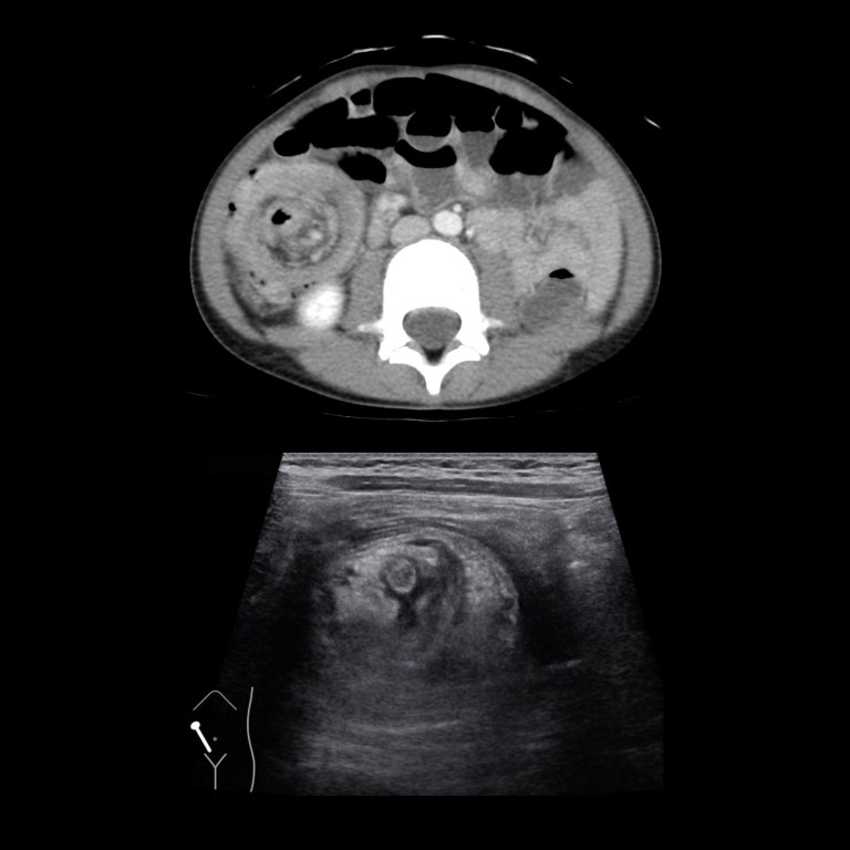 Ileocolic Intussusception | Pediatric Radiology Reference Article ...