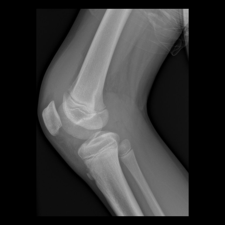 School ager with a swollen knee | Pediatric Radiology Case | Pediatric ...