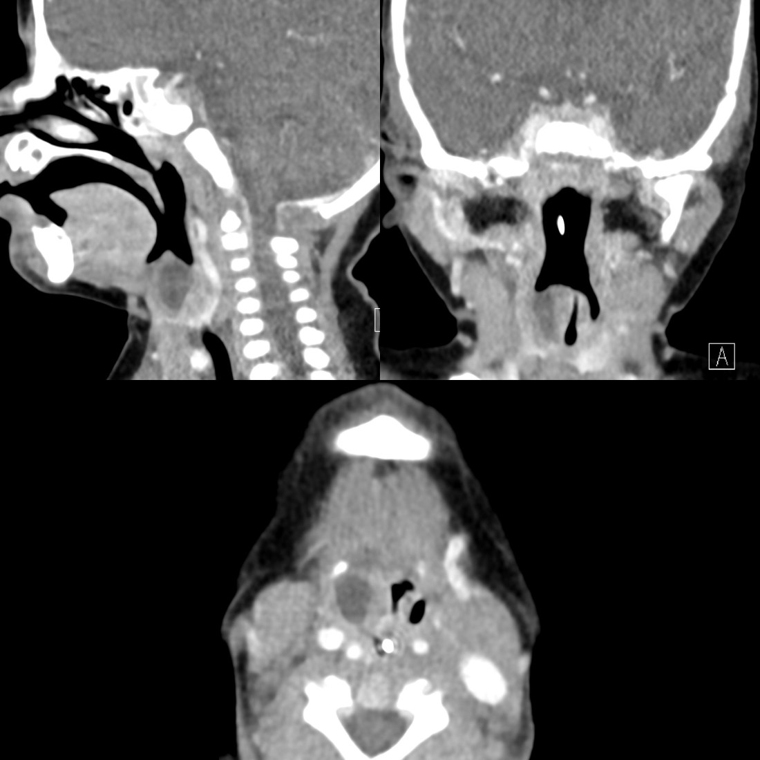 Pediatric Laryngeal Cyst | Pediatric Radiology Reference Article ...