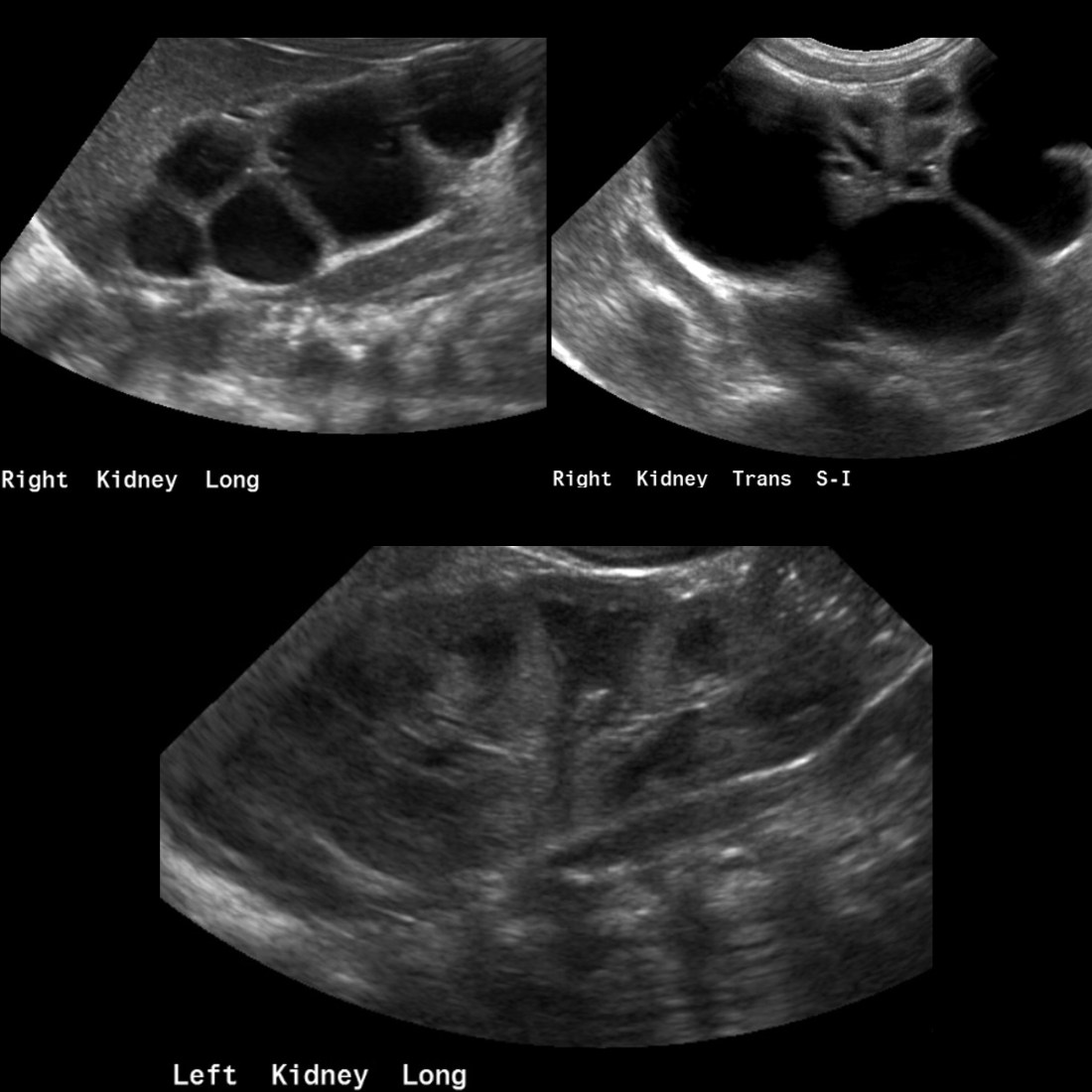 Multicystic Dysplastic Kidney | Pediatric Radiology Reference Article ...