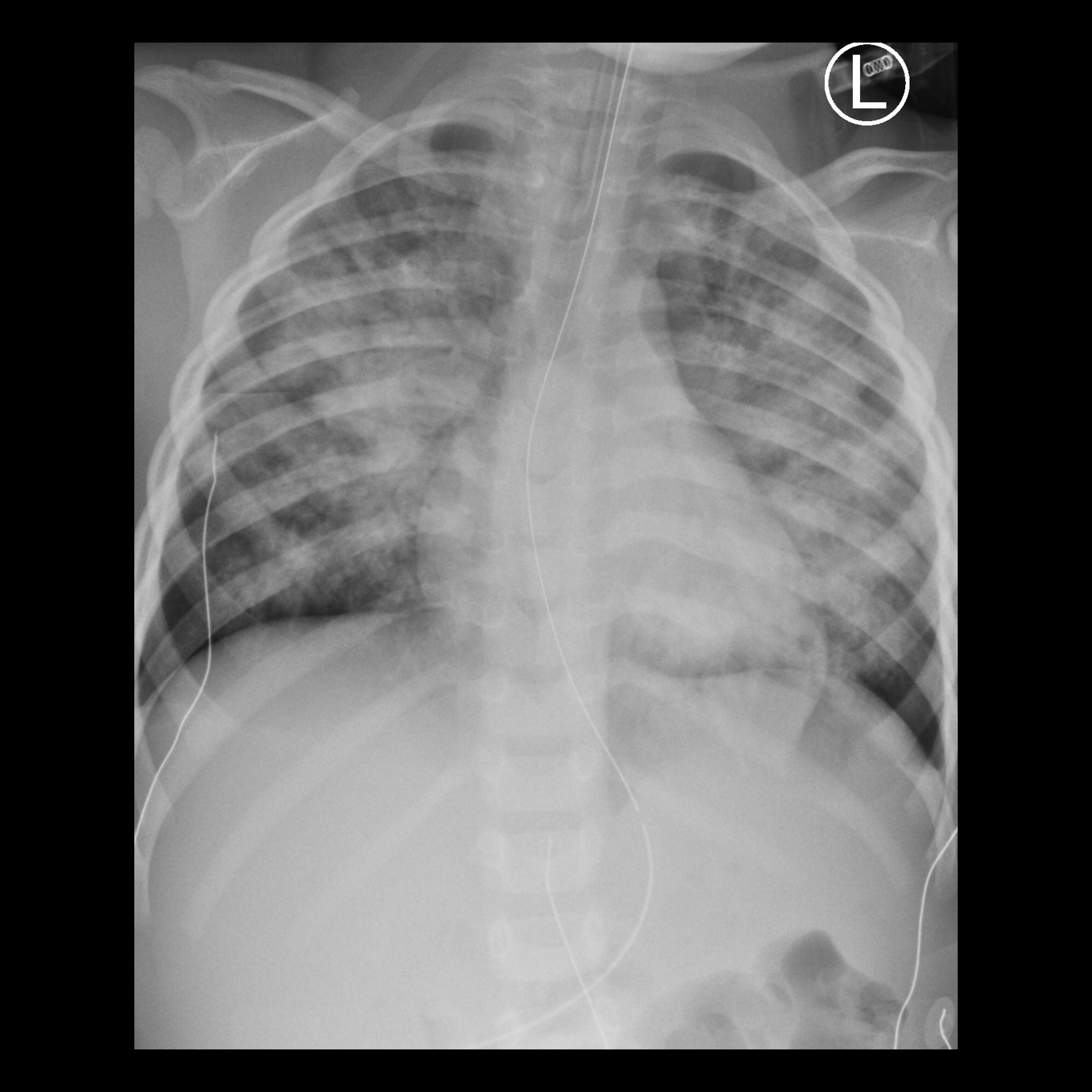 Pediatric Pulmonary Edema | Pediatric Radiology Reference Article ...