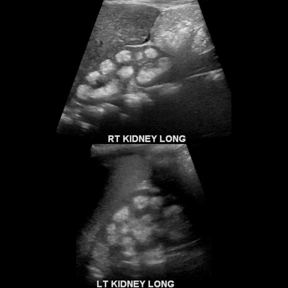 Pediatric Nephrocalcinosis | Pediatric Radiology Reference Article ...
