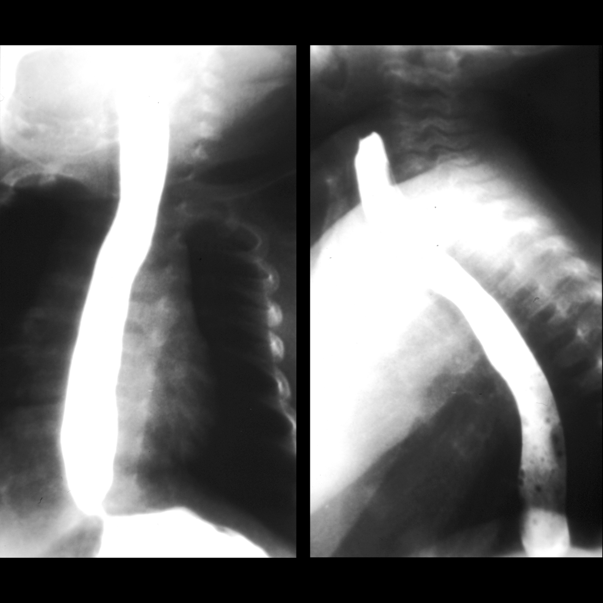 Normal Fluoroscopic Appearance of the Pediatric Gastrointestinal Tract ...