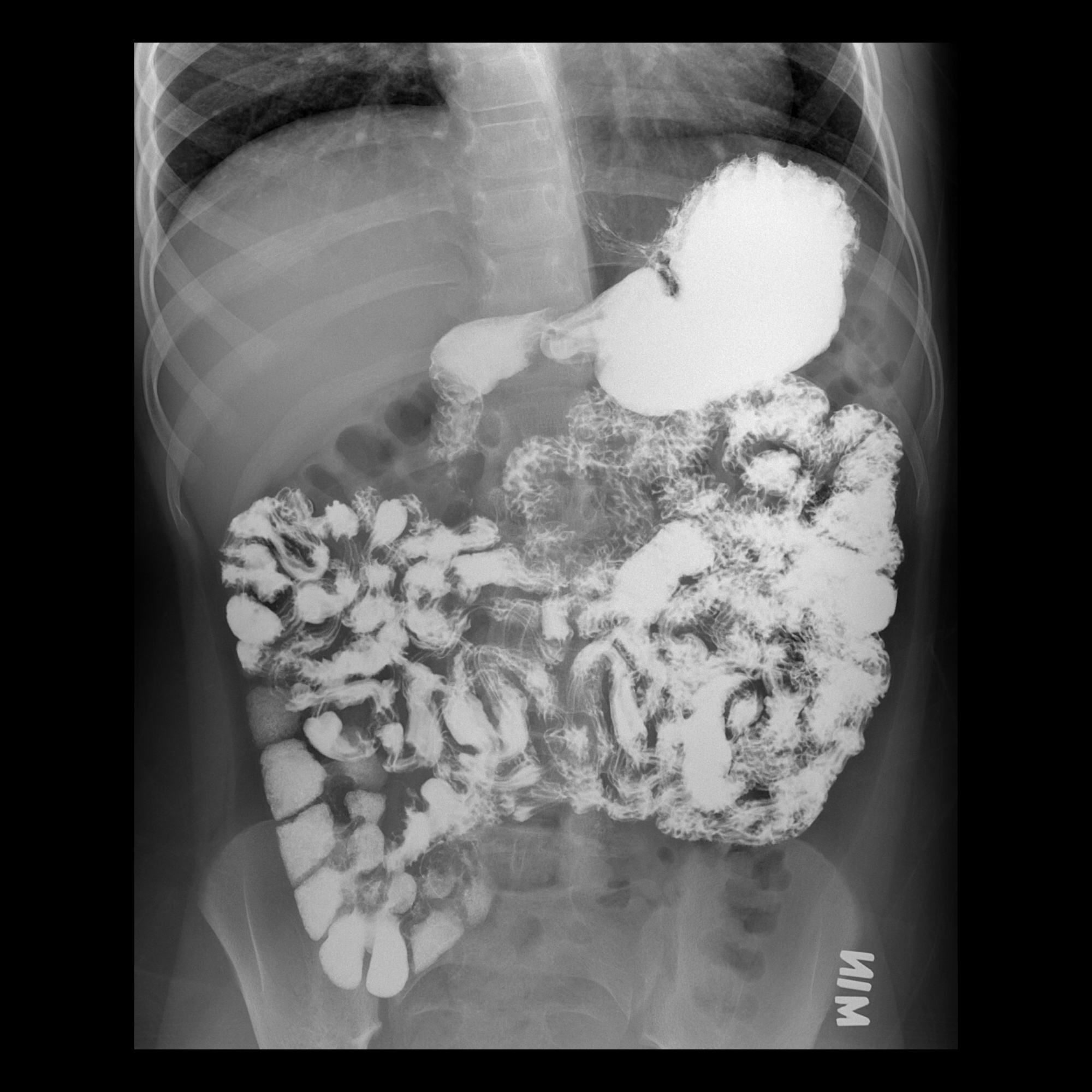 Normal Fluoroscopic Appearance of the Pediatric Gastrointestinal Tract ...