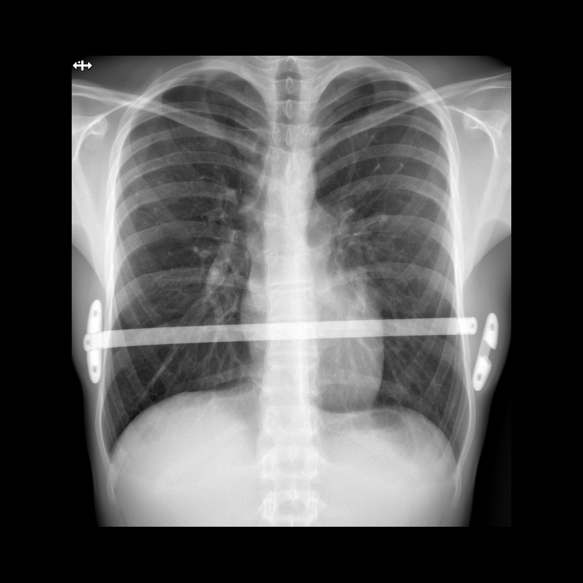 Pediatric Nuss Bar Malfunction | Pediatric Radiology Reference Article ...