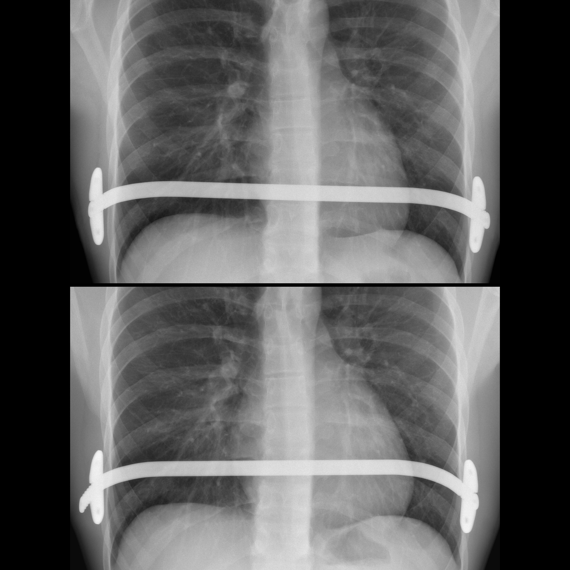 Teenager after Nuss bar placement | Pediatric Radiology Case ...