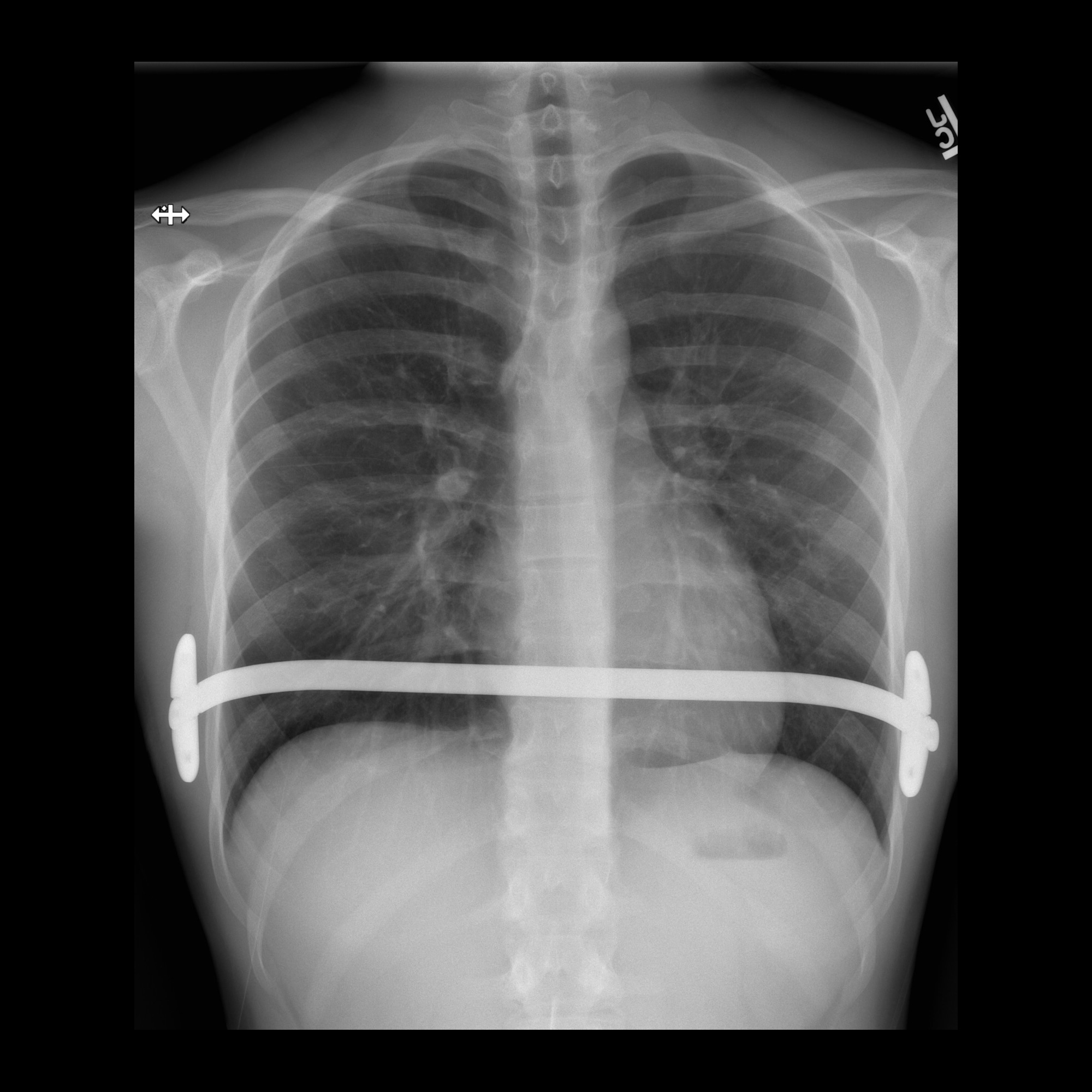 Pectus Excavatum | Pediatric Radiology Reference Article | Pediatric ...
