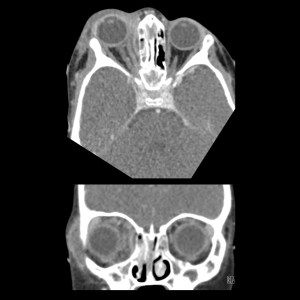 Pediatric Orbital Cellulitis | Pediatric Radiology Reference Article ...