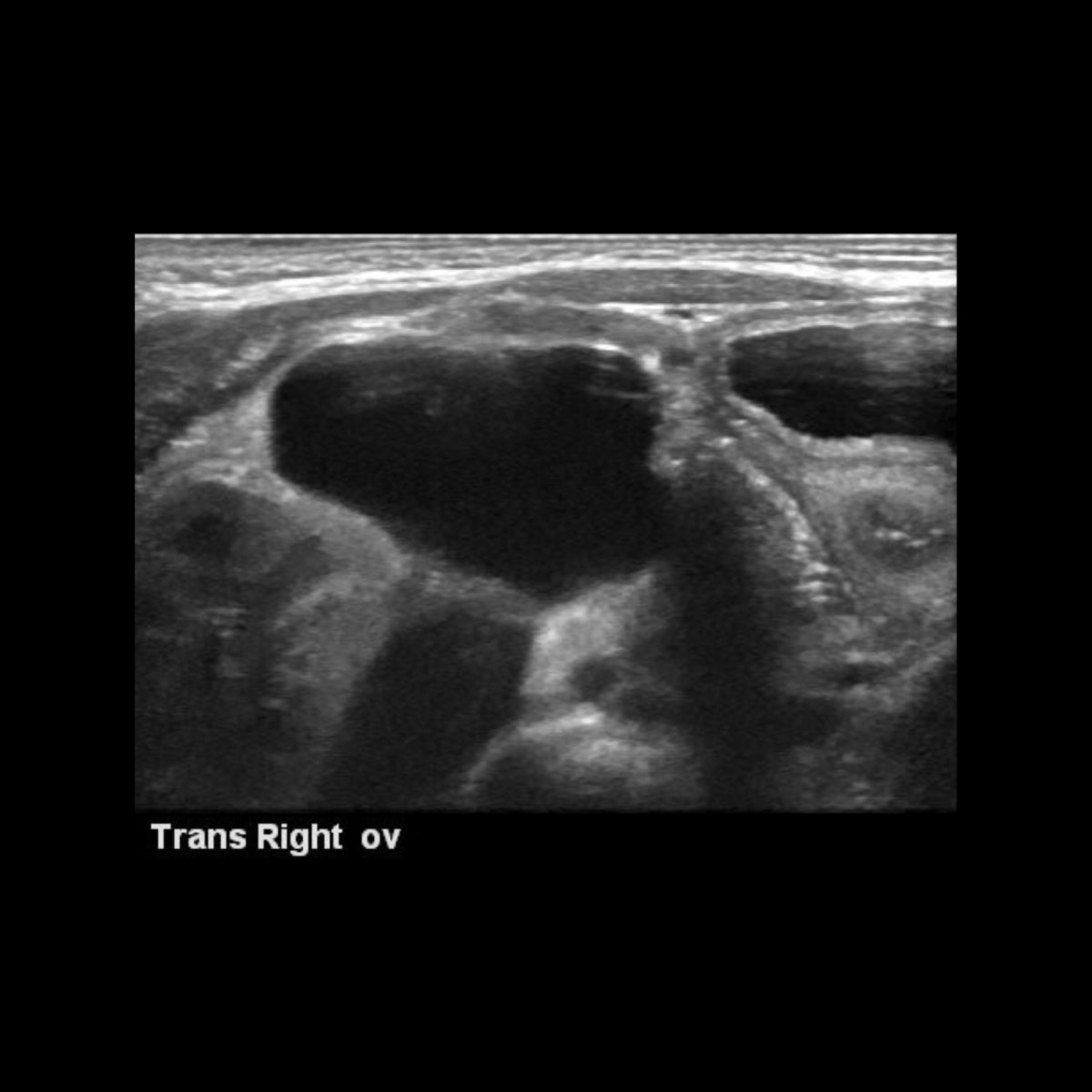Newborn with an abdominal cyst on prenatal US | Pediatric Radiology ...