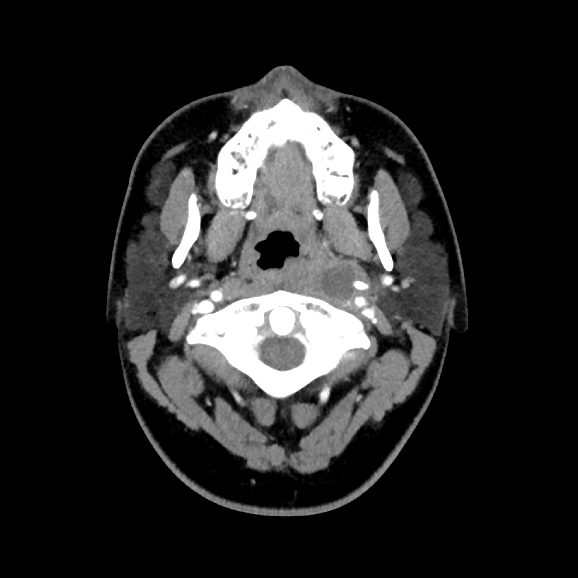 Pediatric Parapharyngeal Abscess | Pediatric Radiology Reference ...