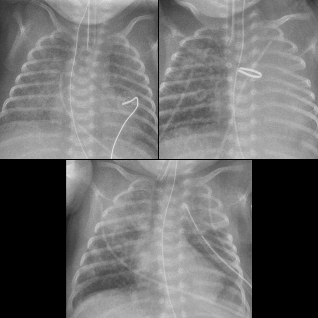 Premature newborn now 1 month old with a patent ductus arteriosus ...