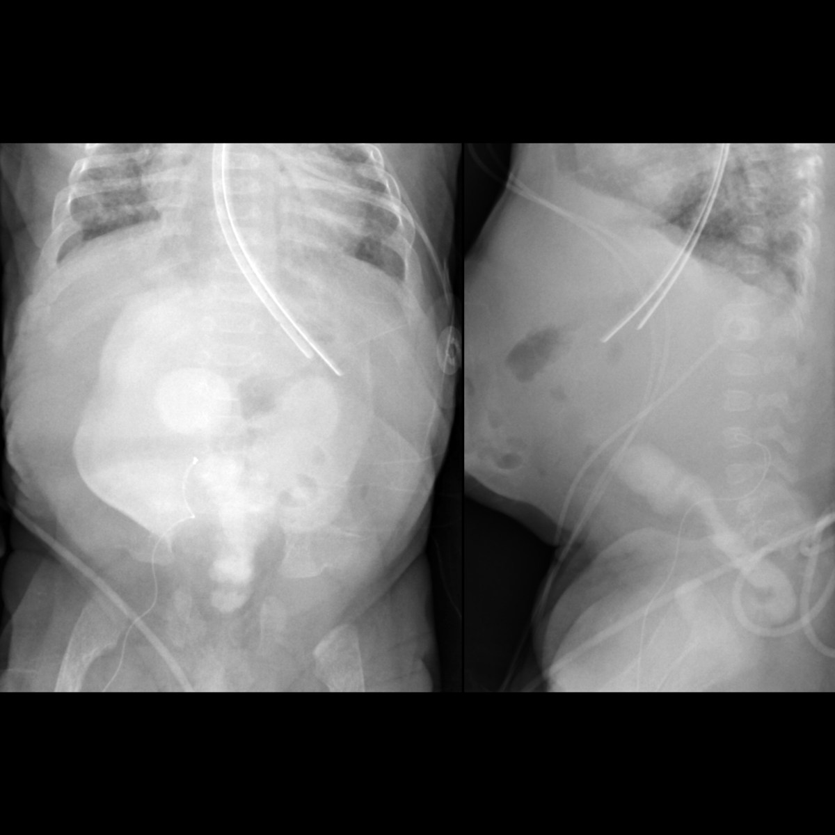 Infant with an omphalocele after lower extremity PICC line placement ...