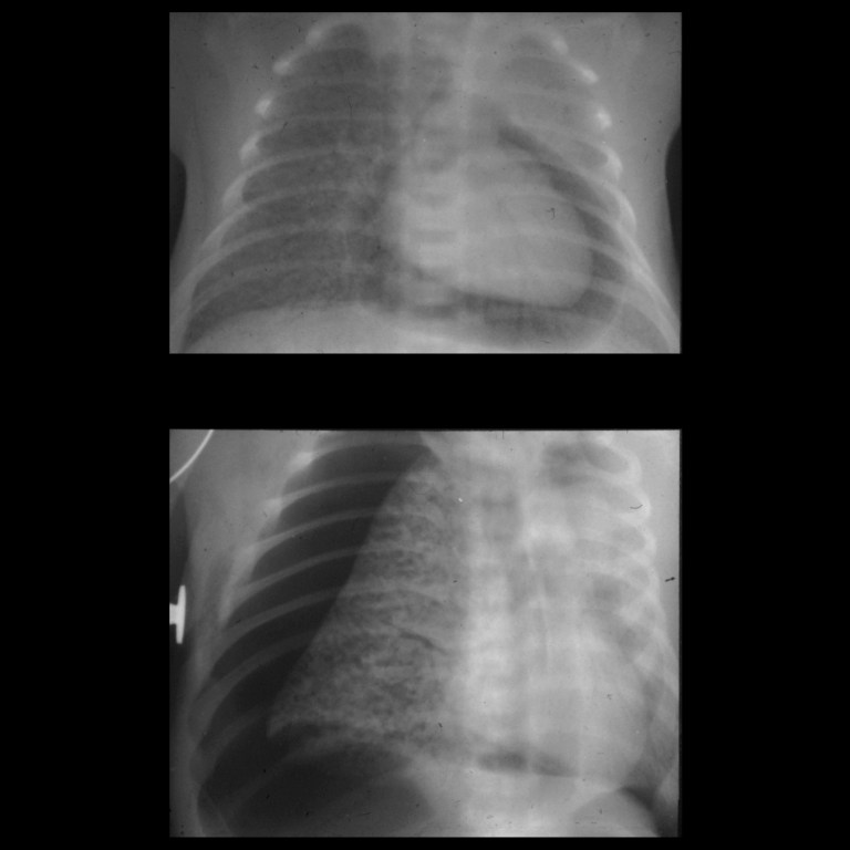 Pulmonary Interstitial Emphysema | Pediatric Radiology Reference ...