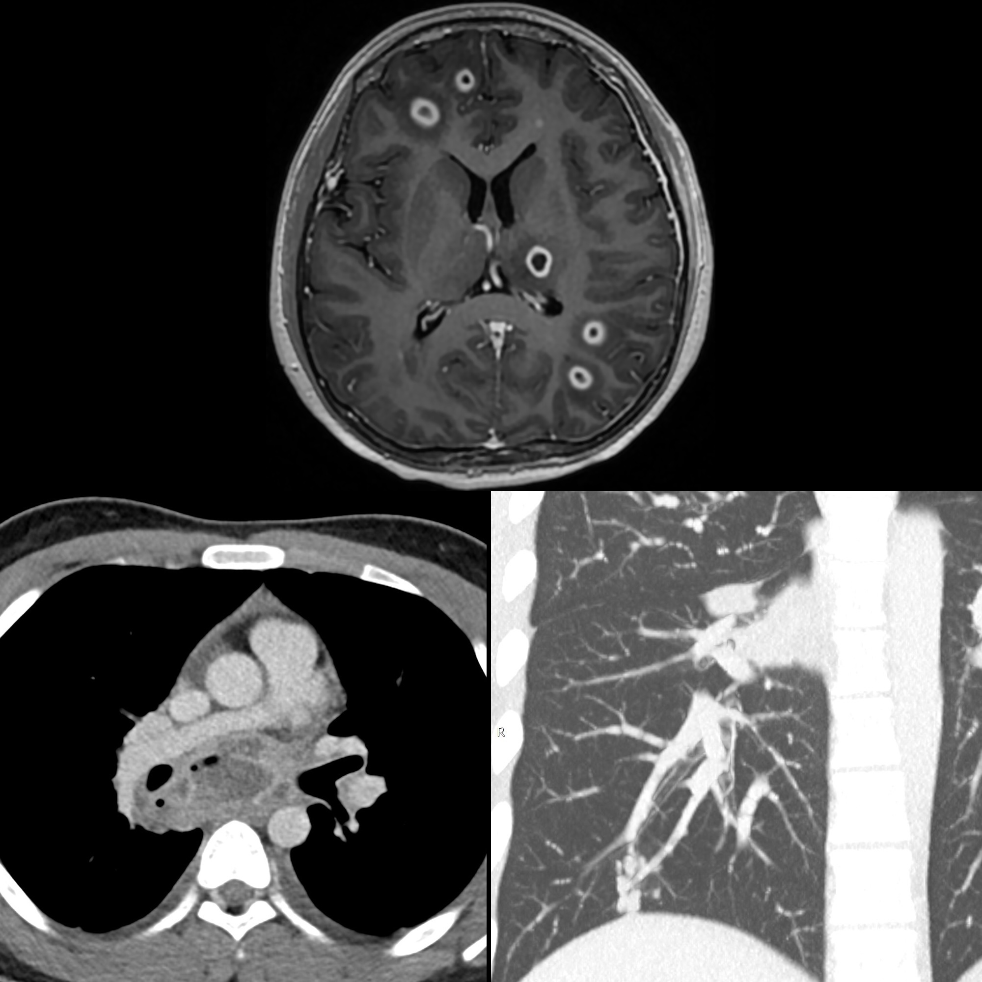 Pediatric Cerebritis and Pediatric Cerebral Abscess | Pediatric ...