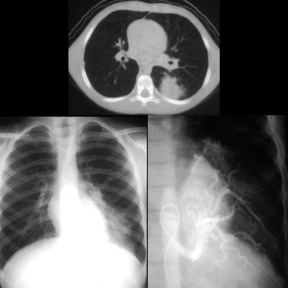 Pulmonary Sequestration | Pediatric Radiology Reference Article ...