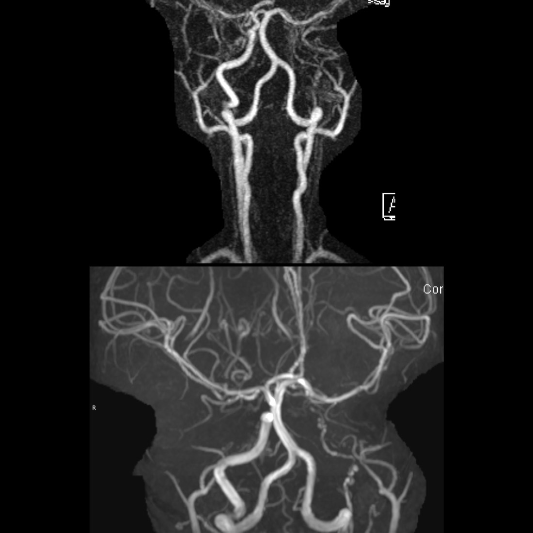 Pediatric Sickle Cell Disease Neurological | Pediatric Radiology ...