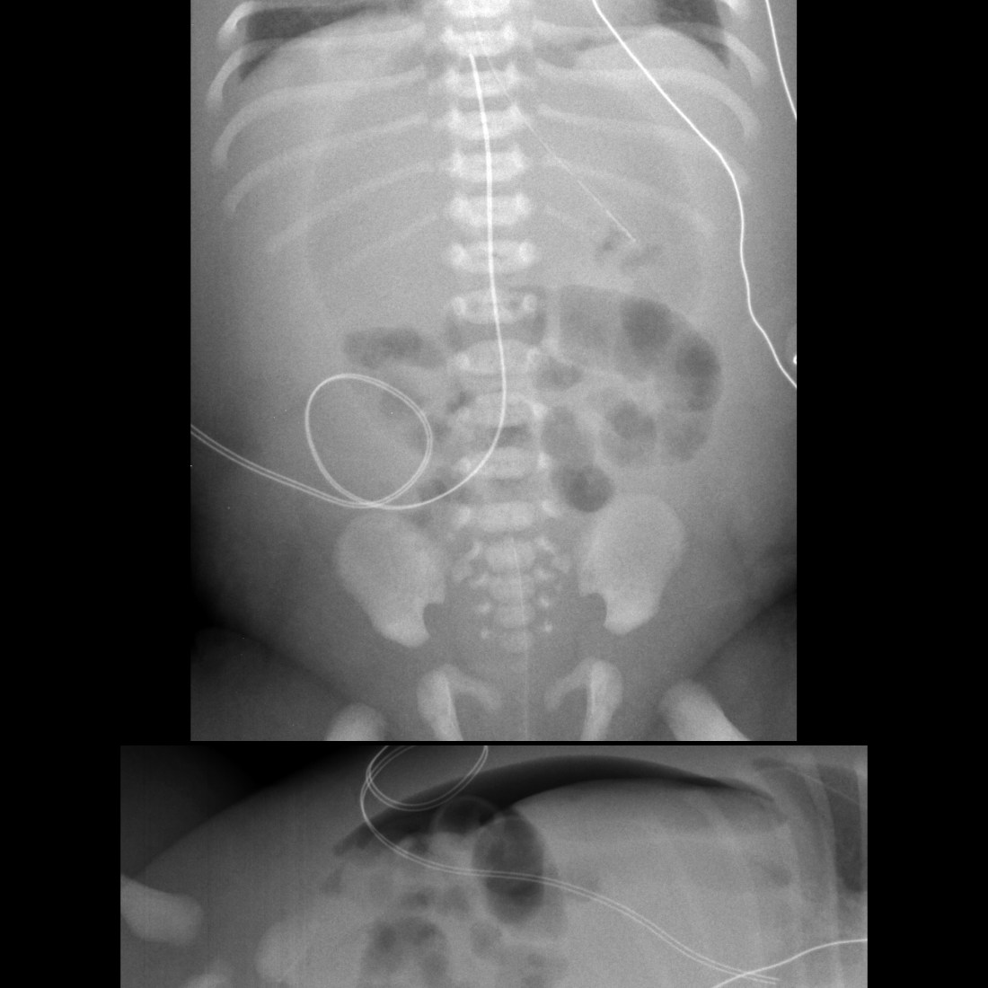 Pediatric Small Bowel Perforation | Pediatric Radiology Reference ...