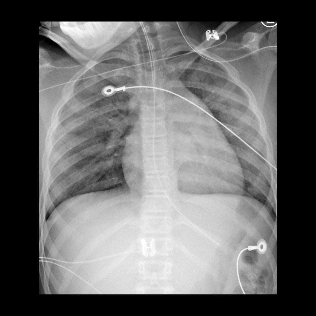 Pulmonary Edema Xray Re Expansion Pulmonary Edema | Radiology Case