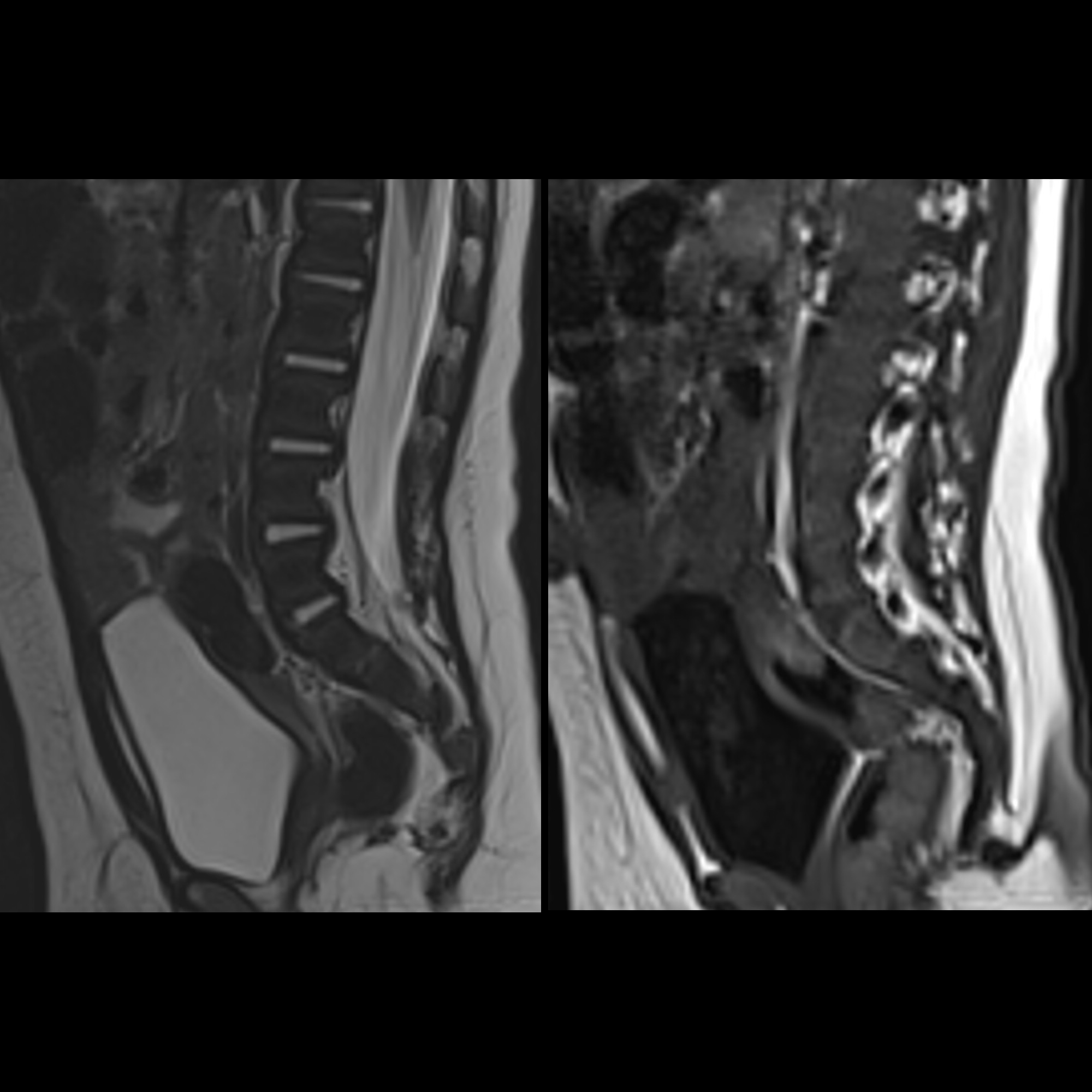 Tethered Cord | Pediatric Radiology Reference Article | Pediatric ...