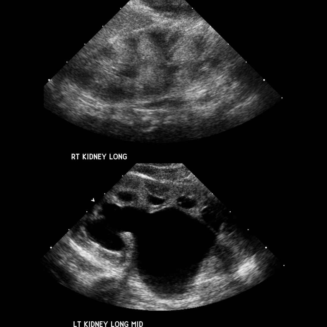 Pediatric Ureteropelvic Junction Obstruction | Pediatric Radiology ...