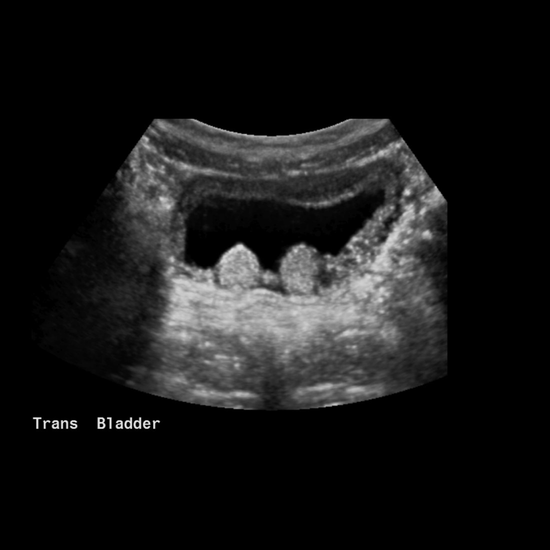 Pediatric Vesicoureteral Reflux | Pediatric Radiology Reference Article ...