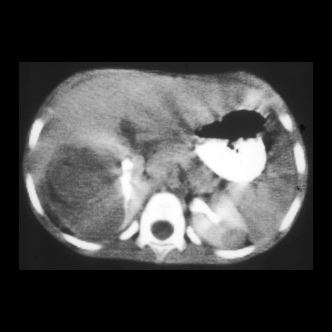 Preschooler with a right sided abdominal mass | Pediatric Radiology ...