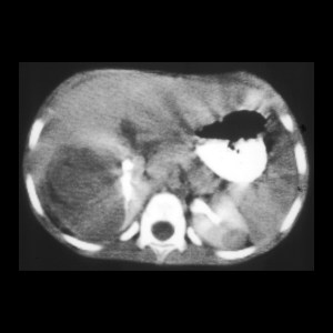 Wilms Tumor | Pediatric Radiology Reference Article | Pediatric Imaging ...