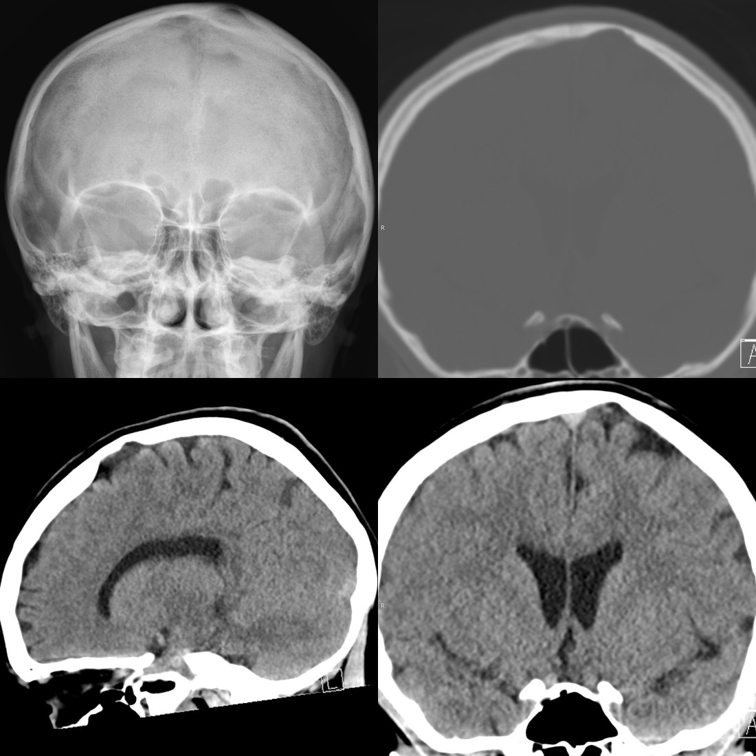 Pediatric Arachnoid Granulations | Pediatric Radiology Reference ...