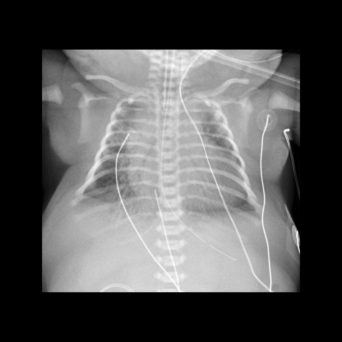 Cardiomyopathy | Pediatric Radiology Reference Article | Pediatric ...