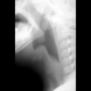 Epiglottitis | Pediatric Radiology Reference Article | Pediatric ...