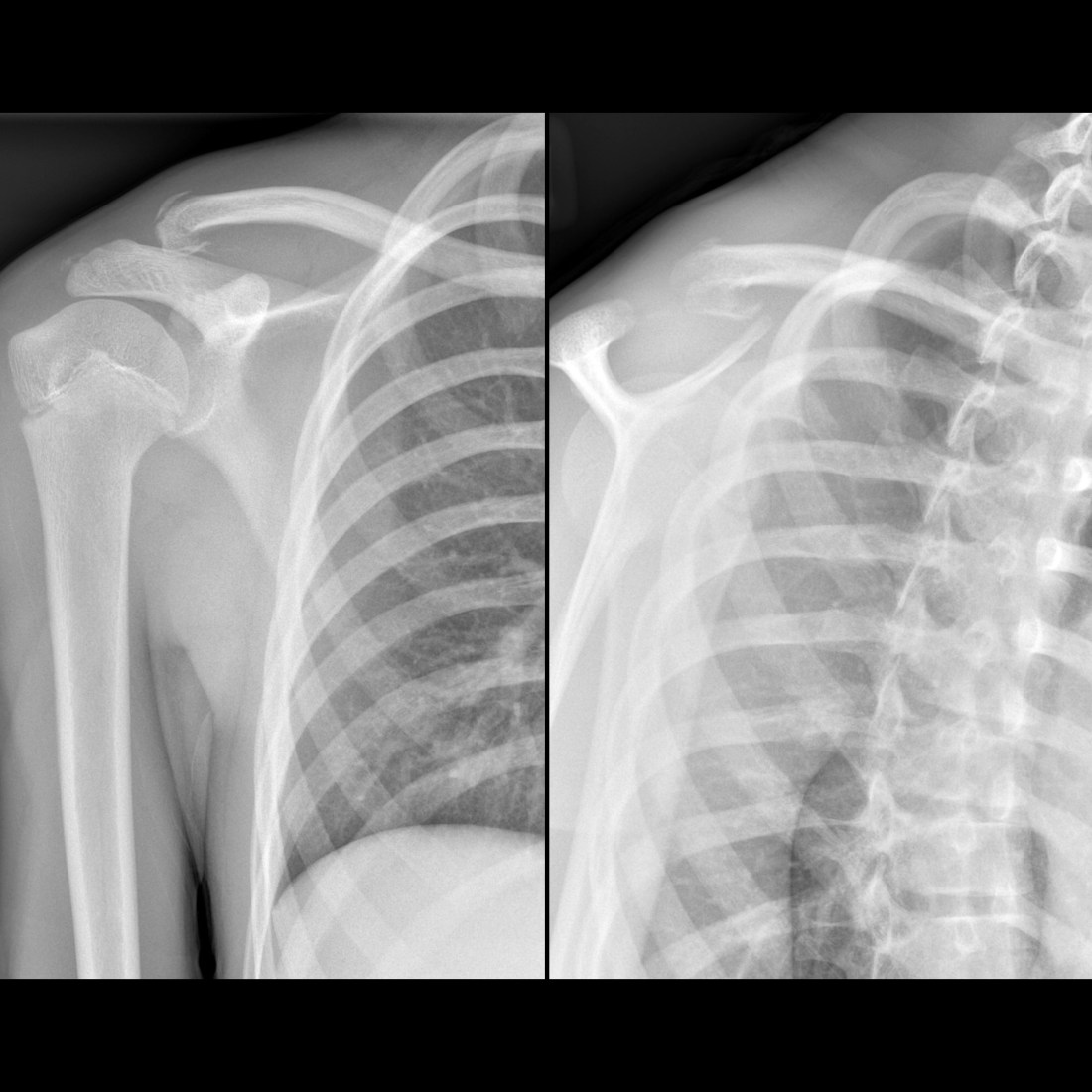Clavicle Fracture | Pediatric Radiology Reference Article | Pediatric ...