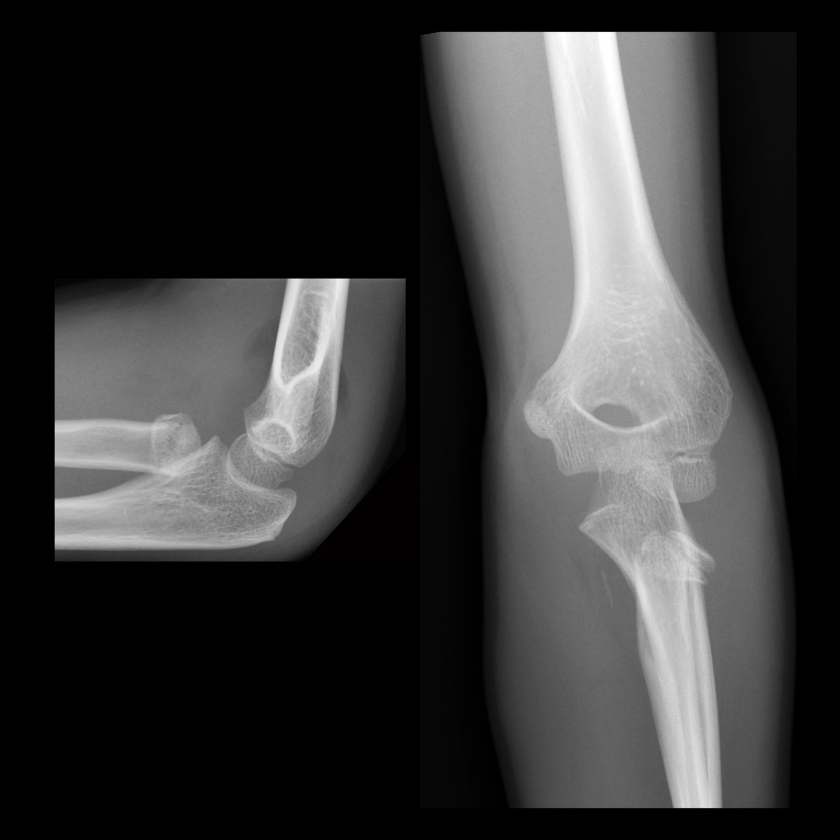 School ager who fell off the monkey bars and now has elbow pain ...