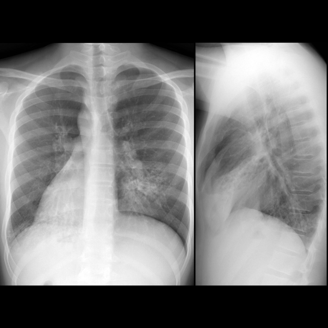 Kartagener Syndrome | Pediatric Radiology Reference Article | Pediatric ...