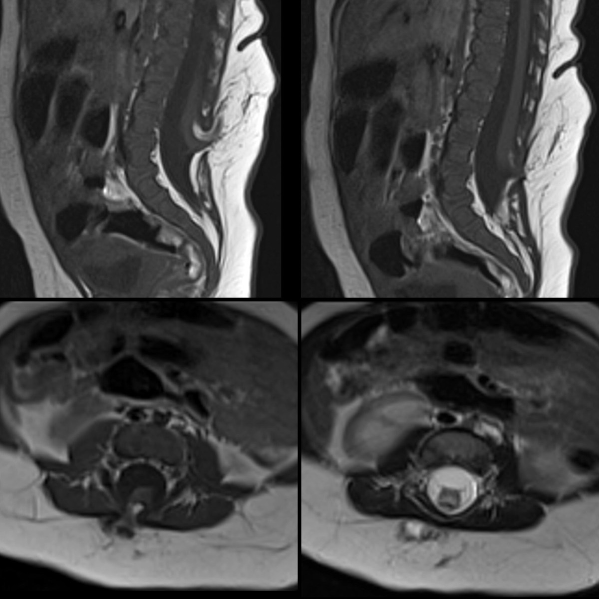 Newborn with a skin covered bump on his lower back | Pediatric ...