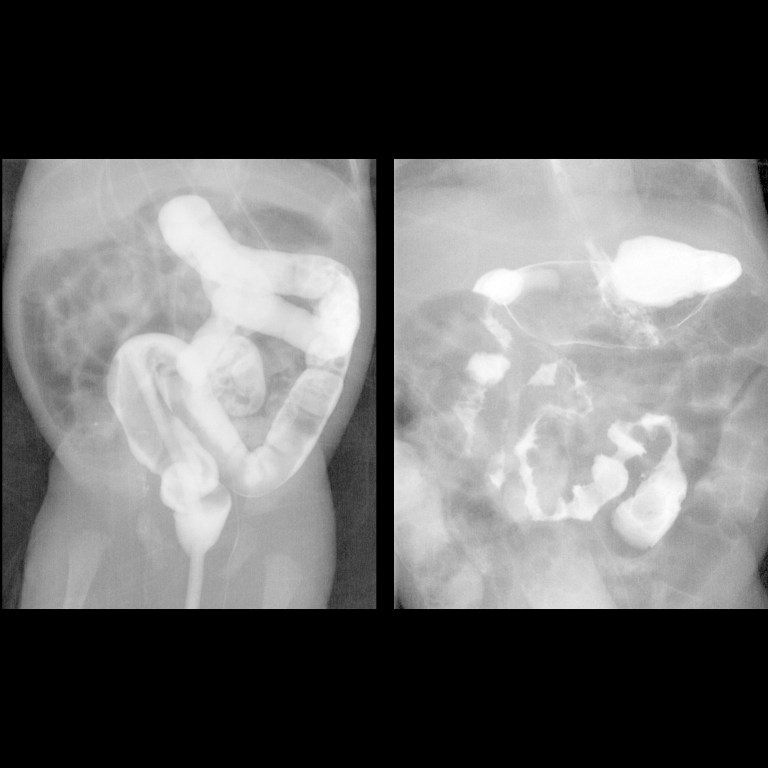 Meconium Plug Syndrome | Pediatric Radiology Reference Article ...