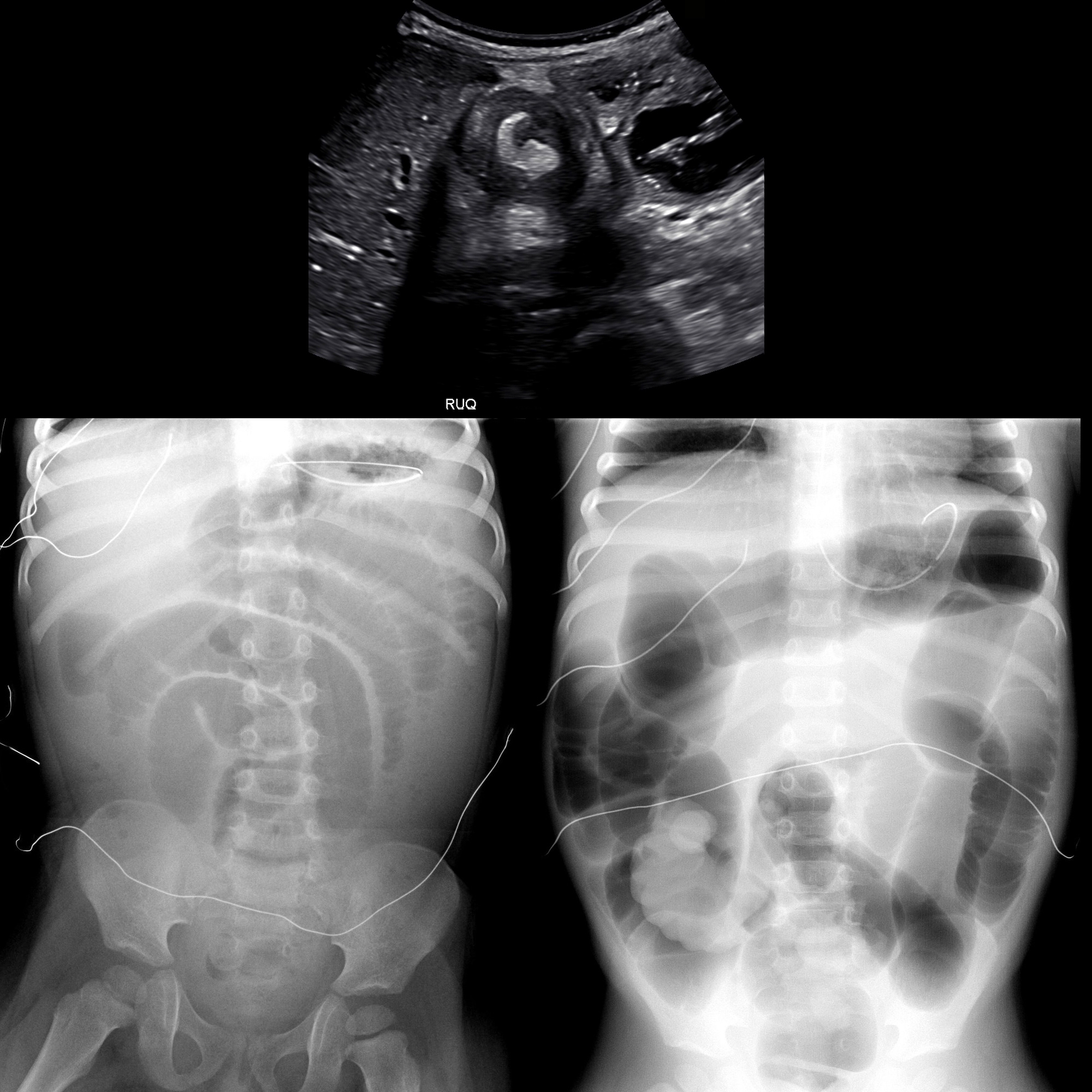 Meckel Diverticulum | Pediatric Radiology Reference Article | Pediatric ...