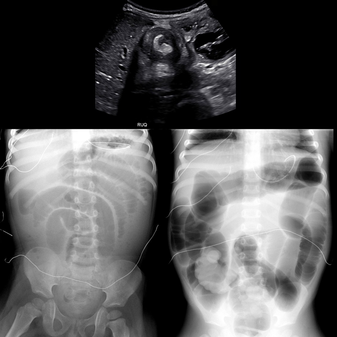 Meckel Diverticulum Xray Intestinal Obstruction Caused By Torsed