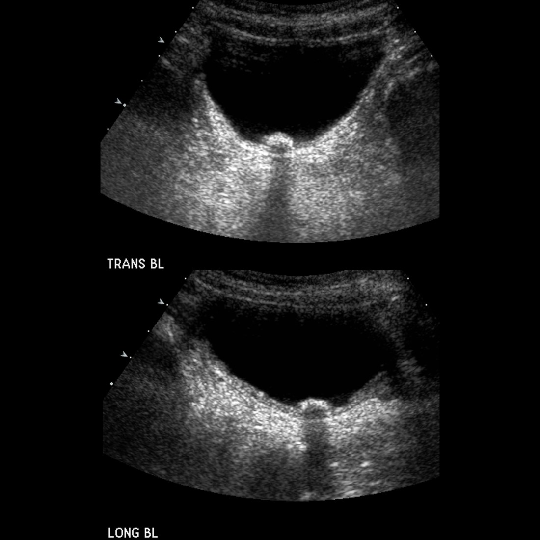 Pediatric Neurogenic Bladder | Pediatric Radiology Reference Article ...