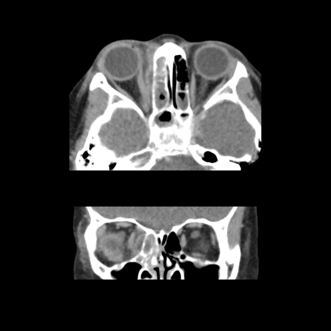 Pediatric Orbital Cellulitis | Pediatric Radiology Reference Article ...