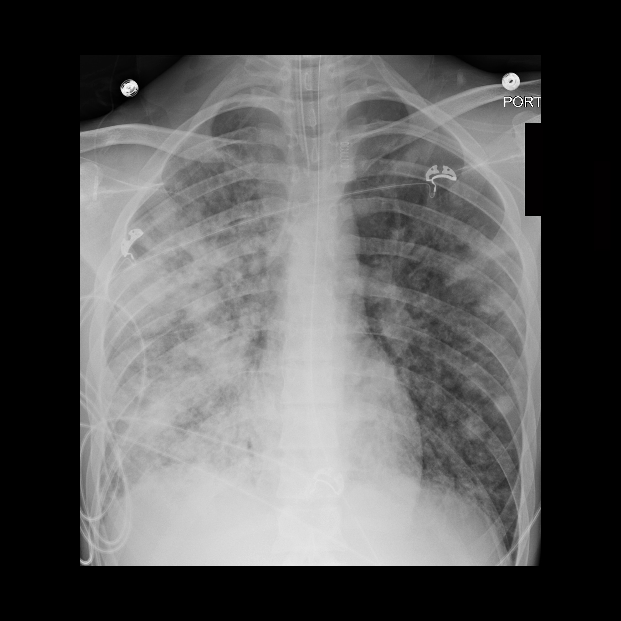Pediatric Pulmonary Fat Embolism | Pediatric Radiology Reference ...