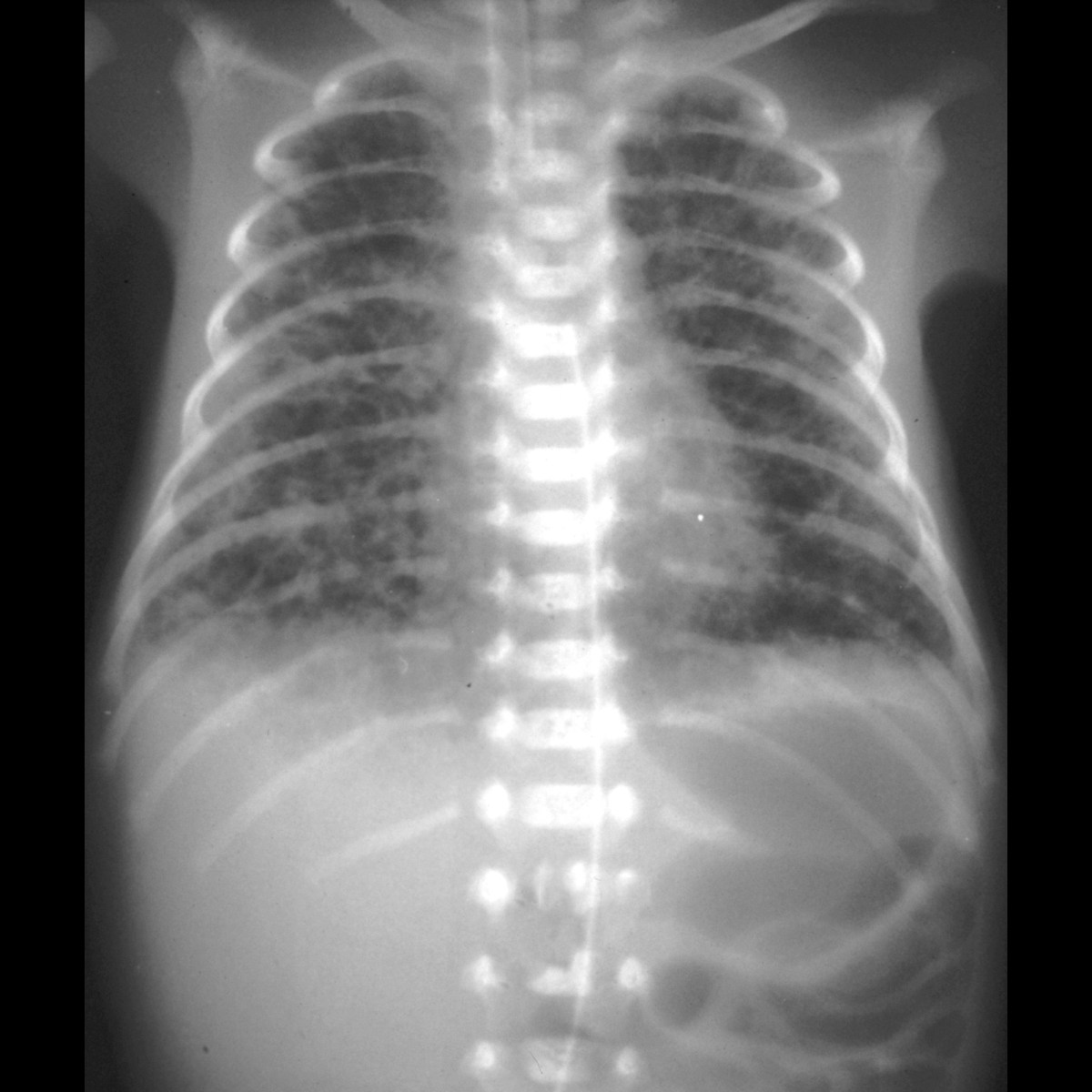 Premature newborn with respiratory distress | Pediatric Radiology Case ...
