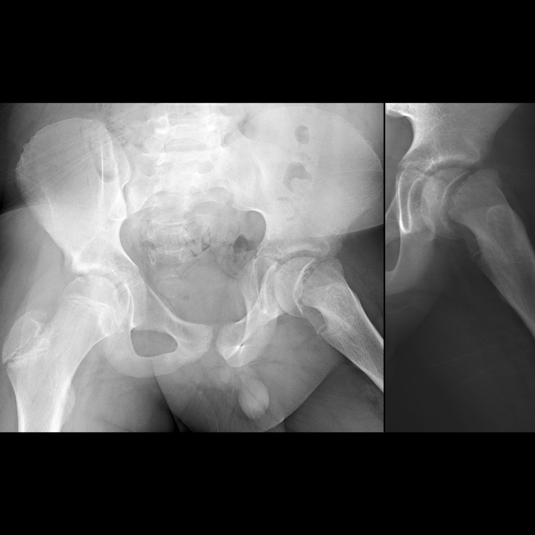 Slipped Capital Femoral Epiphysis | Pediatric Radiology Reference ...