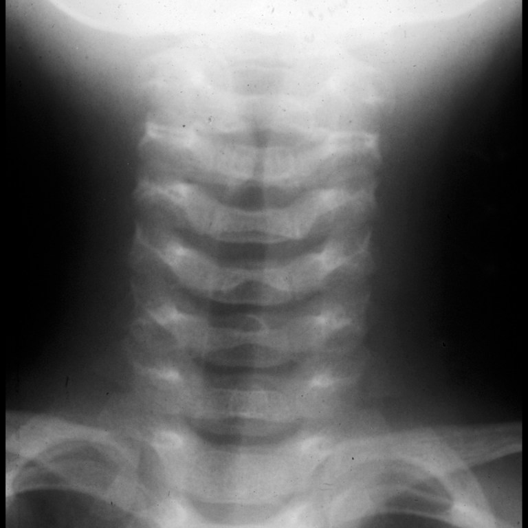 Toddler with stridor who previously had undergone endotracheal ...