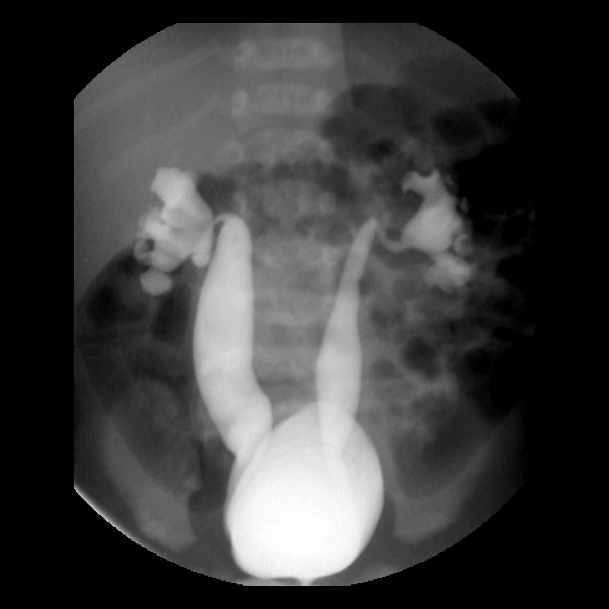 Pediatric Vesicoureteral Reflux | Pediatric Radiology Reference Article ...