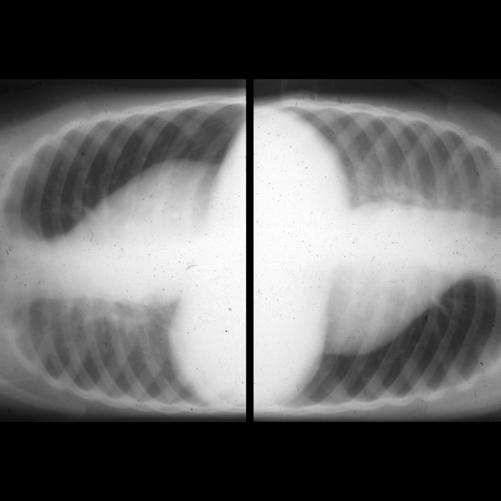 AirwayForeignBody01JAKPeanutLeftBronchusCXRDecub | Pediatric Radiology ...